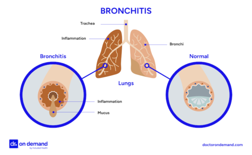 When to See a Doctor for Chest Congestion: When is it serious