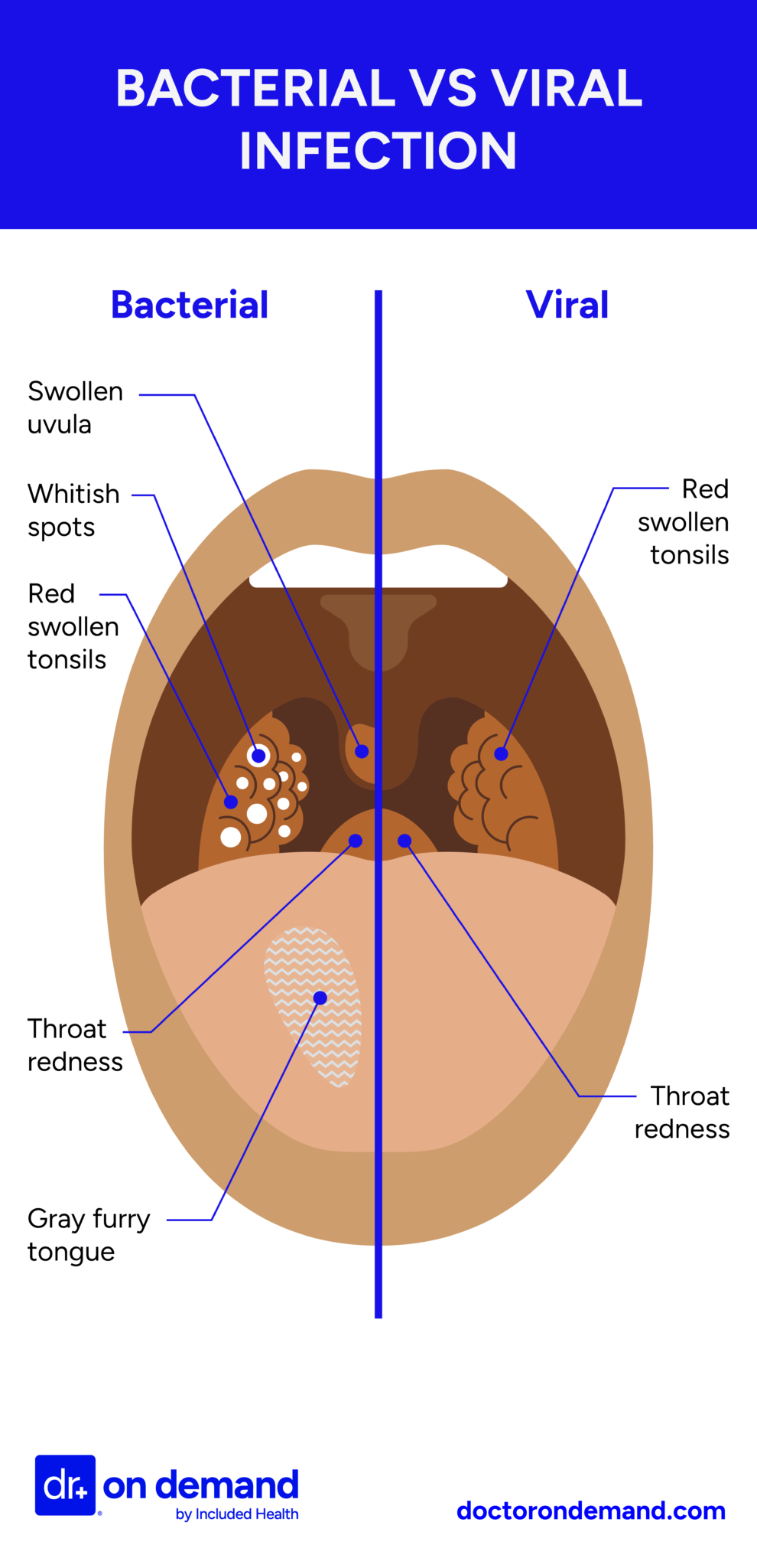 When to Go to Urgent Care for a Sore Throat: When Is It Serious?