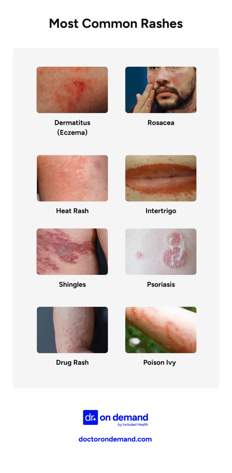 When to go to Urgent Care for Rash: When is a Rash Serious?