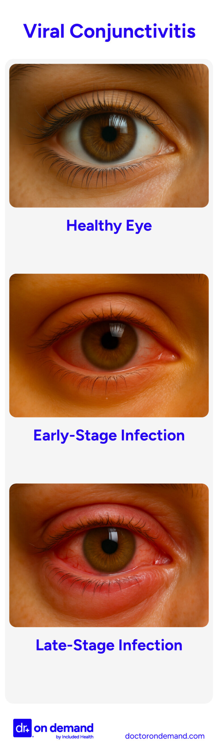 When to Go to the ER for Pink Eye: When Is It Serious? - Doctor On Demand